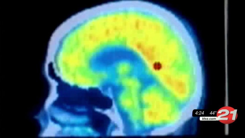 $2.2 million CDC grant to study C.O. traumatic brain injury program - KTVZ